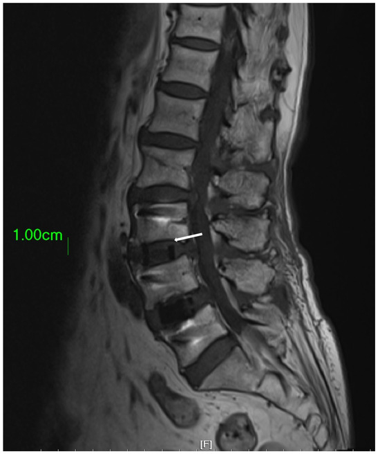 Bioengineering | Free Full-Text | Optimizing Spinal Fusion Cage Design ...