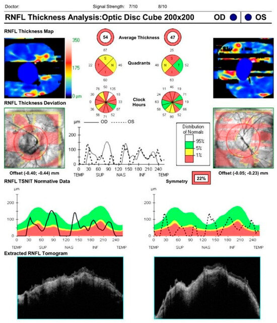 Addressing Glaucoma in Myopic Eyes: Diagnostic and Surgical Challenges