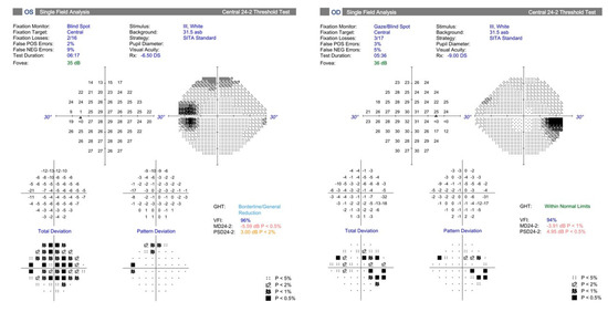 Addressing Glaucoma in Myopic Eyes: Diagnostic and Surgical Challenges