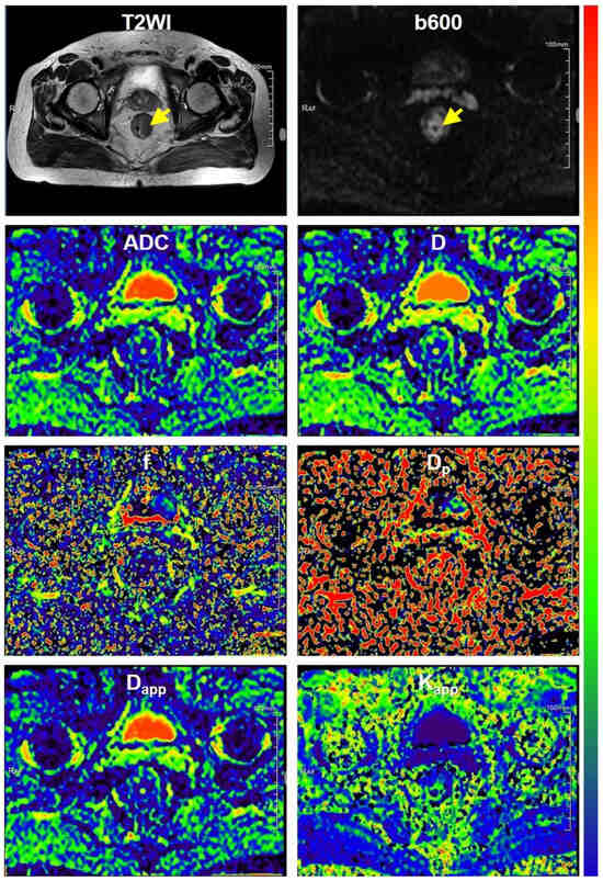 Preoperative Grading of Rectal Cancer with Multiple DWI Models, DWI ...