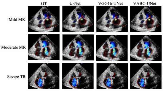 Automatic Segmentation and Assessment of Valvular Regurgitations with ...