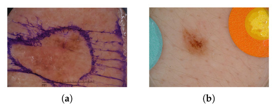 Artificial Intelligence Algorithms for Benign vs. Malignant Dermoscopic ...
