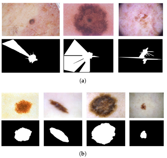 Artificial Intelligence Algorithms for Benign vs. Malignant Dermoscopic ...