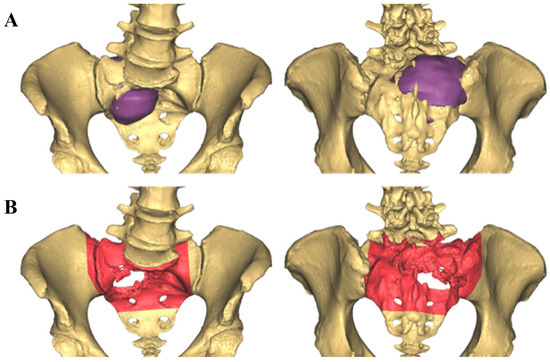 Advances in Virtual Cutting Guide and Stereotactic Navigation for ...