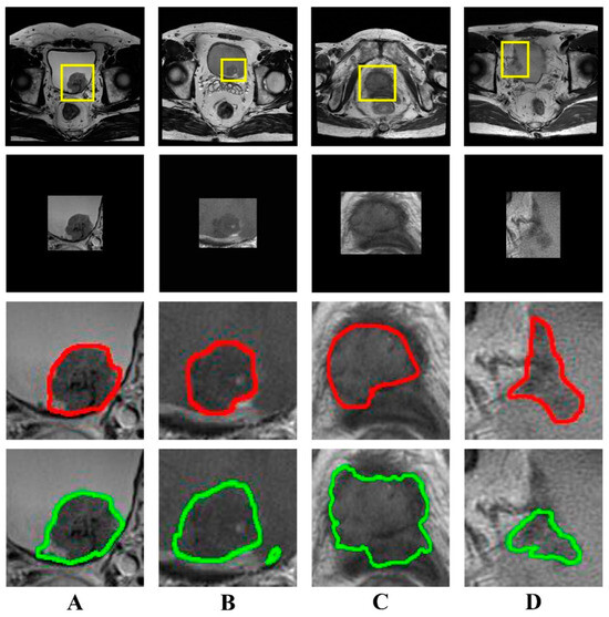 Radiomics Prediction of Muscle Invasion in Bladder Cancer Using Semi-Automatic Lesion ...