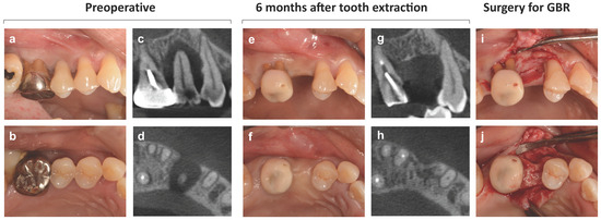 Bioengineering | Free Full-Text | Biomaterials for Alveolar Ridge Preservation as a Preoperative ...