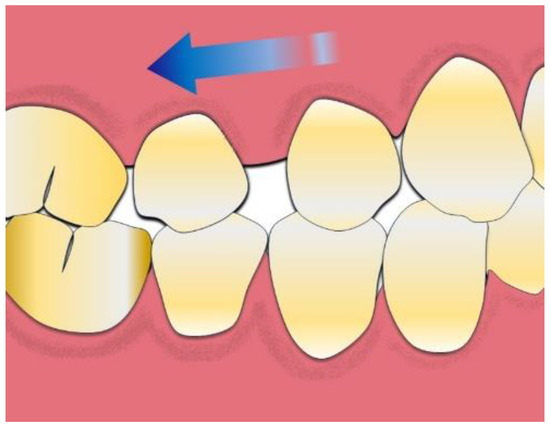 Predictability of Dental Distalization with Clear Aligners: A ...