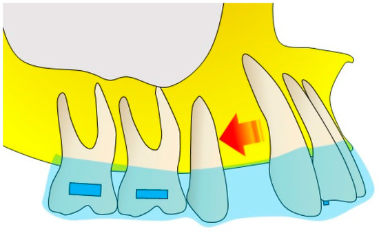 Predictability of Dental Distalization with Clear Aligners: A ...