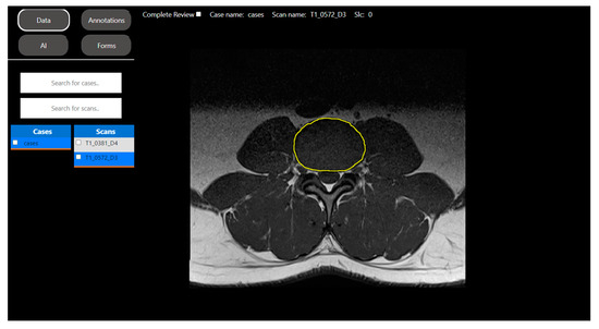 Discovery Viewer (DV): Web-Based Medical AI Model Development Platform ...