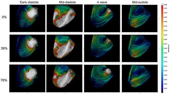 Left Ventricular Assist Device Pump Obstruction Reduces Native Heart ...