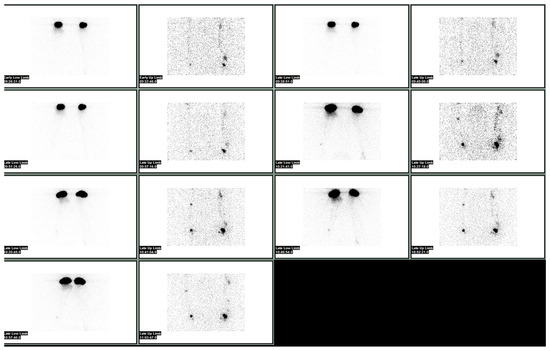 The Role of Imaging of Lymphatic System to Prevent Cancer Related ...