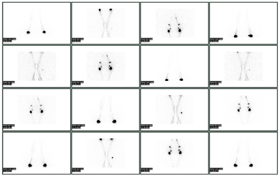 The Role of Imaging of Lymphatic System to Prevent Cancer Related ...