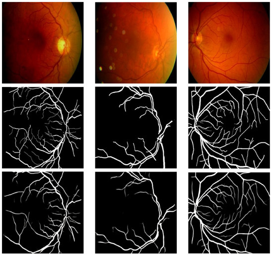 GAN-Based Approach for Diabetic Retinopathy Retinal Vasculature Segmentation