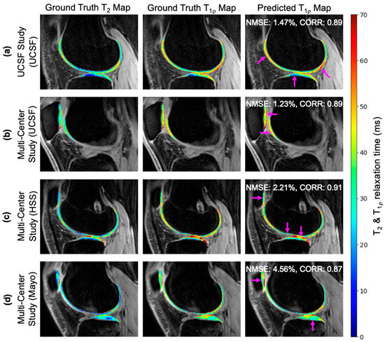 Bioengineering | Free Full-Text | Synthetic Knee MRI T1p Maps as an ...