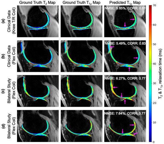 Bioengineering | Free Full-Text | Synthetic Knee MRI T1p Maps as an ...