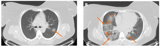 Bioengineering | Free Full-Text | COVID-19 Detection and Diagnosis ...