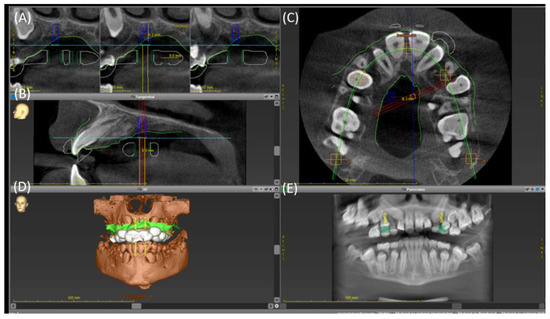 Mini-Implant Insertion Using a Guide Manufactured with Computer-Aided ...