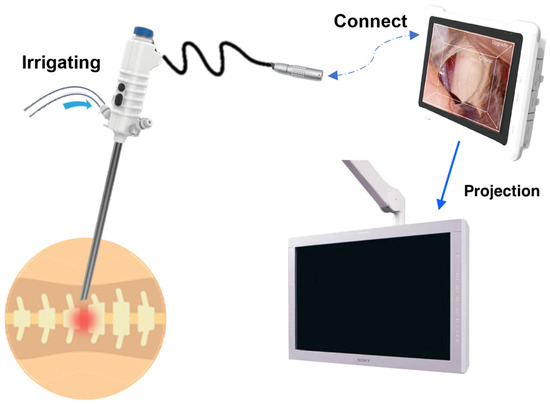 The Evolution of Spinal Endoscopy: Design and Image Analysis of a ...