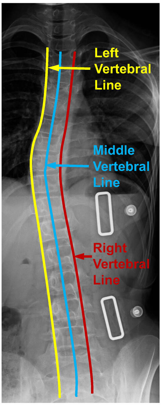 A Dual Coordinate System Vertebra Landmark Detection Network with ...