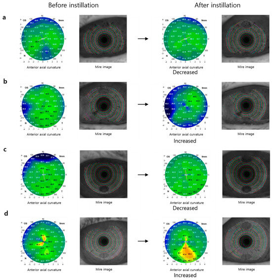Artificial Tear Instillation-Induced Changes in Corneal Topography