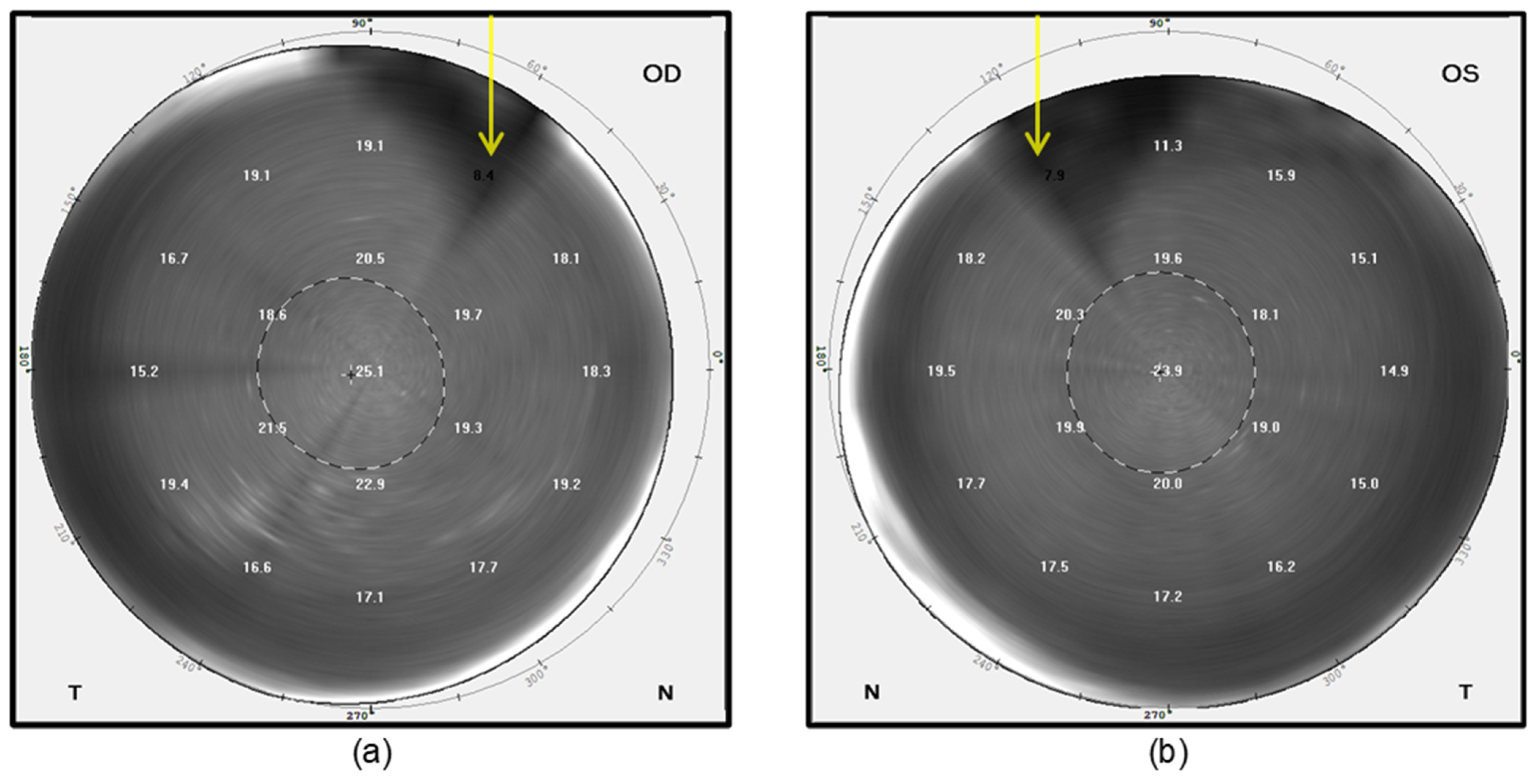 Investigation of How Corneal Densitometry Artefacts Affect the Imaging ...