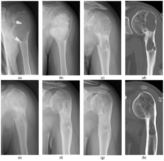 Bone-Regeneration Therapy Using Biodegradable Scaffolds: Calcium ...