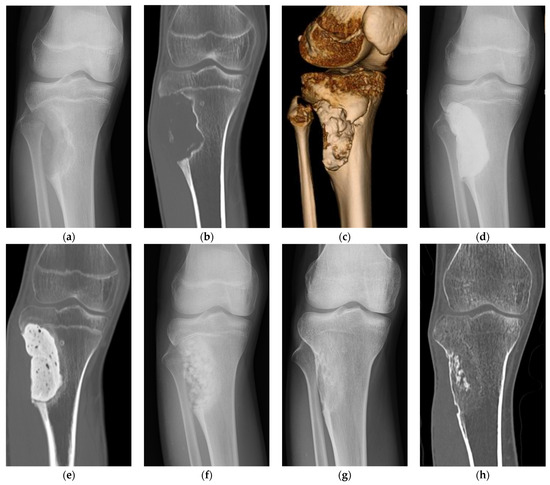 Bone-Regeneration Therapy Using Biodegradable Scaffolds: Calcium ...