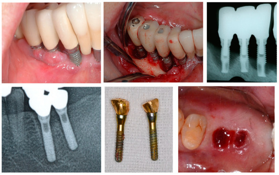 Risk Factors for Early Implant Failure and Selection of Bone Grafting ...