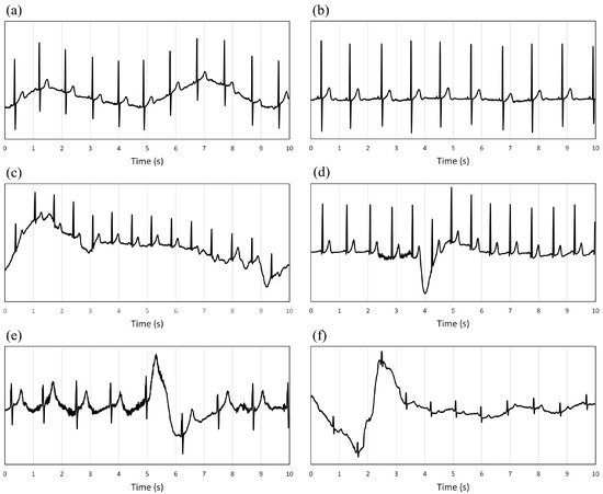 Validation of a New and Straightforward Algorithm to Evaluate Signal Quality during ECG ...