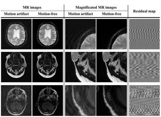 Motion Artifact Reduction Using U-Net Model with Three-Dimensional ...