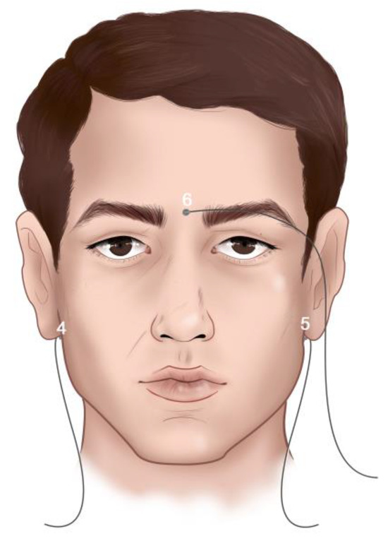 Determination of Micromovements in Removable Prosthesis during ...