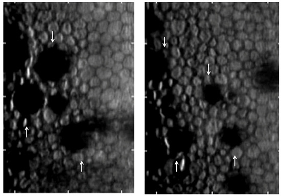 Applications of Imaging Technologies in Fuchs Endothelial Corneal ...
