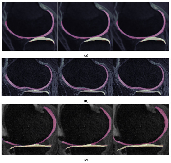 Dense Multi-Scale Graph Convolutional Network for Knee Joint Cartilage ...