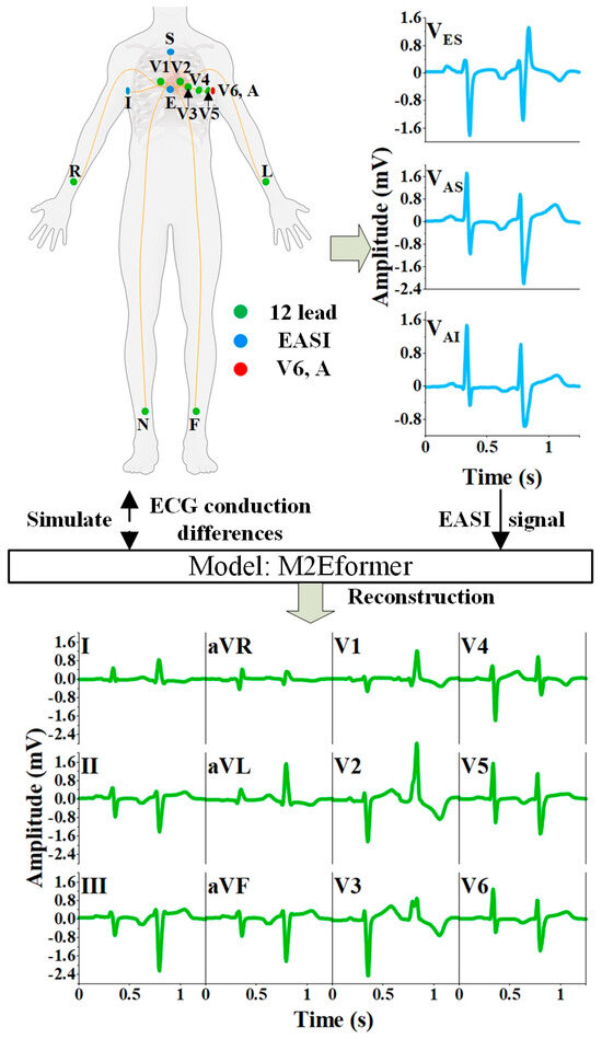 Wearable 12-Lead ECG Acquisition Using a Novel Deep Learning Approach ...