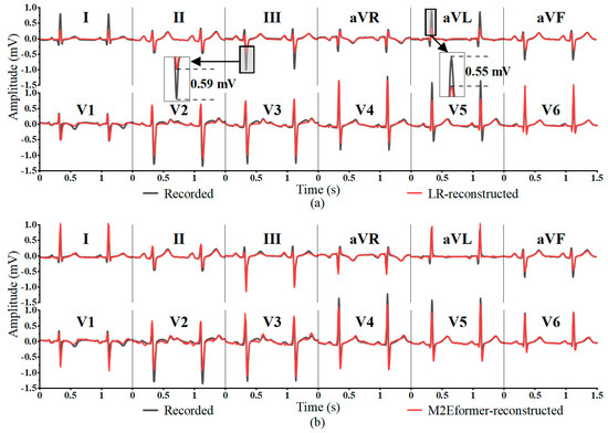 Wearable 12-Lead ECG Acquisition Using a Novel Deep Learning Approach ...