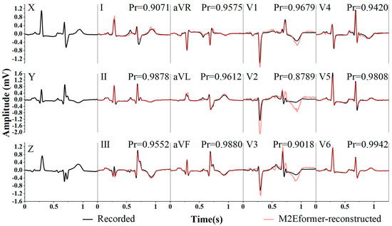 Wearable 12-Lead ECG Acquisition Using a Novel Deep Learning Approach ...