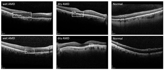 Enhancing Readability and Detection of Age-Related Macular Degeneration ...