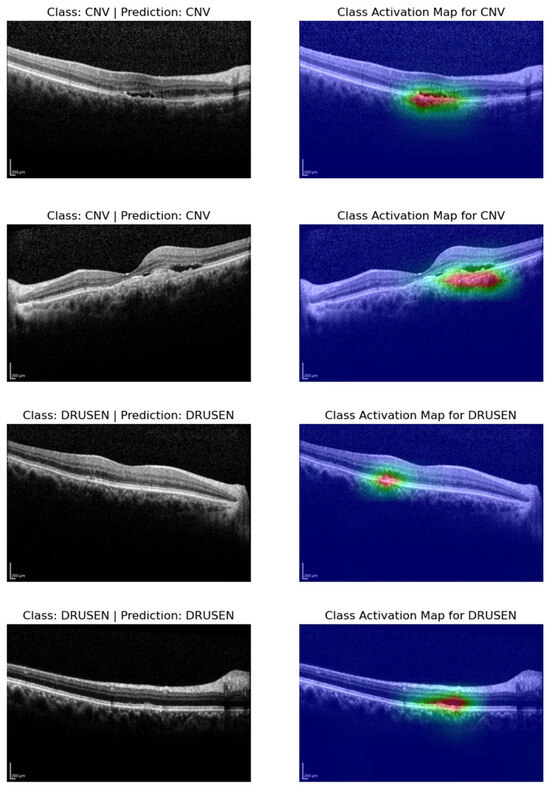 Enhancing Readability and Detection of Age-Related Macular Degeneration ...