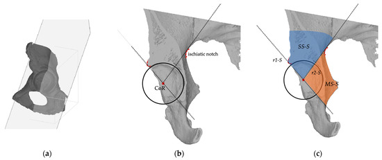 Quantitative Assessment of Acetabular Defects in Revision Hip ...