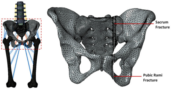 Bioengineering | Free Full-Text | Pelvic Ring Fractures: A ...