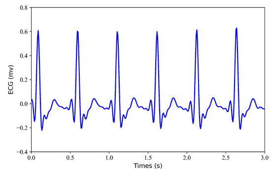 Reconstruction of Missing Electrocardiography Signals from ...