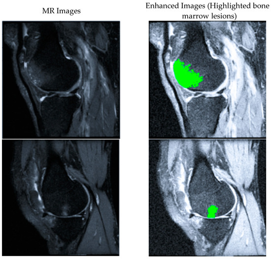 Automatic Segmentation of Bone Marrow Lesions on MRI Using a Deep Learning Method