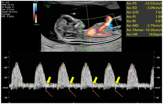 Fetal Aortic Blood Flow Velocity and Power Doppler Profiles in the ...