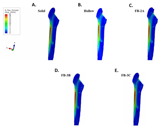 Debulking of the Femoral Stem in a Primary Total Hip Joint Replacement ...