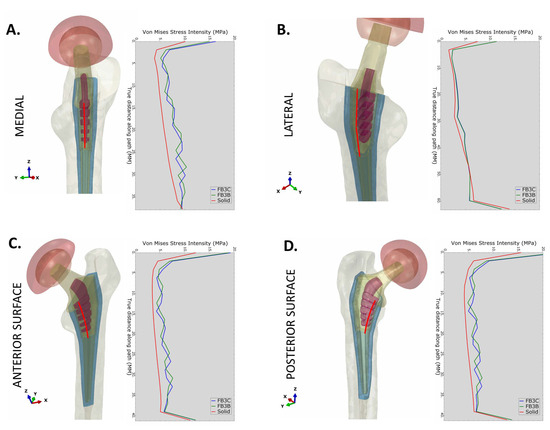 Debulking of the Femoral Stem in a Primary Total Hip Joint Replacement ...