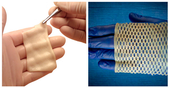 Decellularized Human Dermis for Orthoplastic Extremity Reconstruction