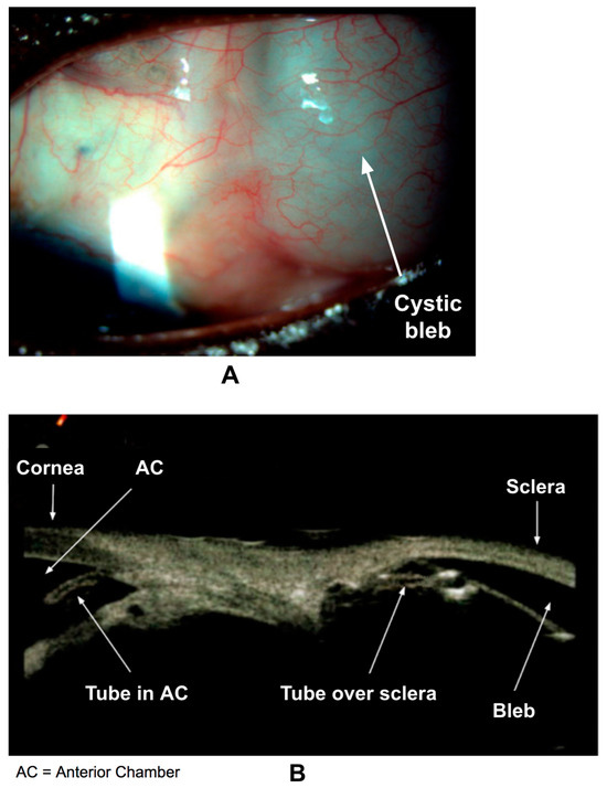 Wound Modulations in Glaucoma Surgery: A Systematic Review