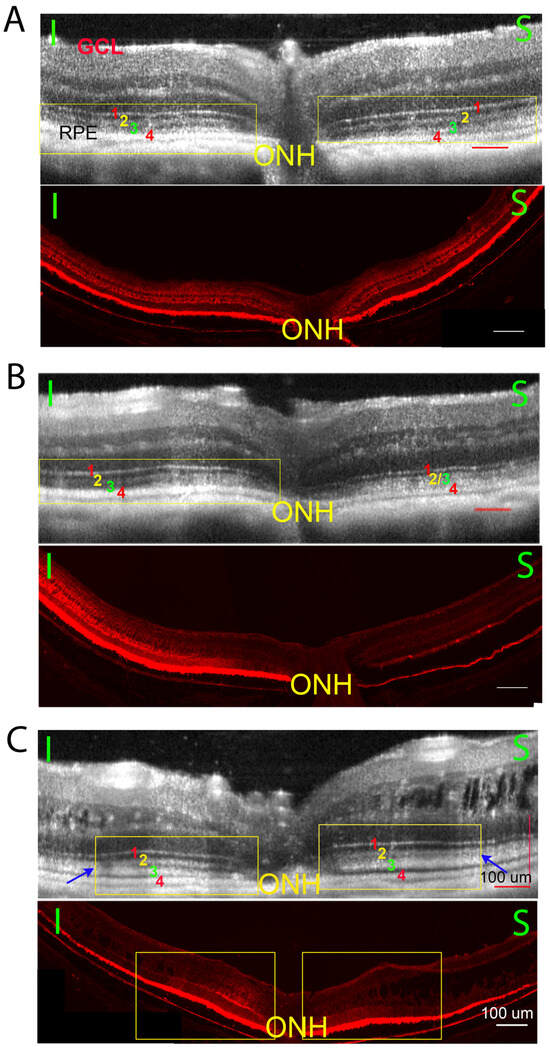 OCT Intensity of the Region between Outer Retina Band 2 and Band 3 as a ...