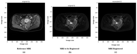 Preoperative Molecular Subtype Classification Prediction of Ovarian ...