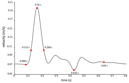 Endovascular Treatment of Intracranial Aneurysm: The Importance of the ...